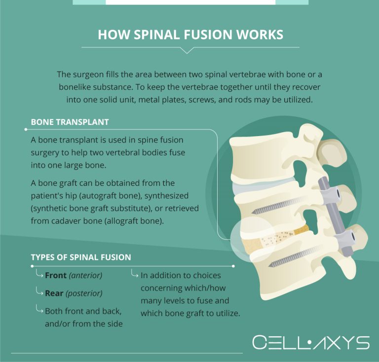 Spinal Fusion Surgery [What Is It And How It Works?] - Cellaxys