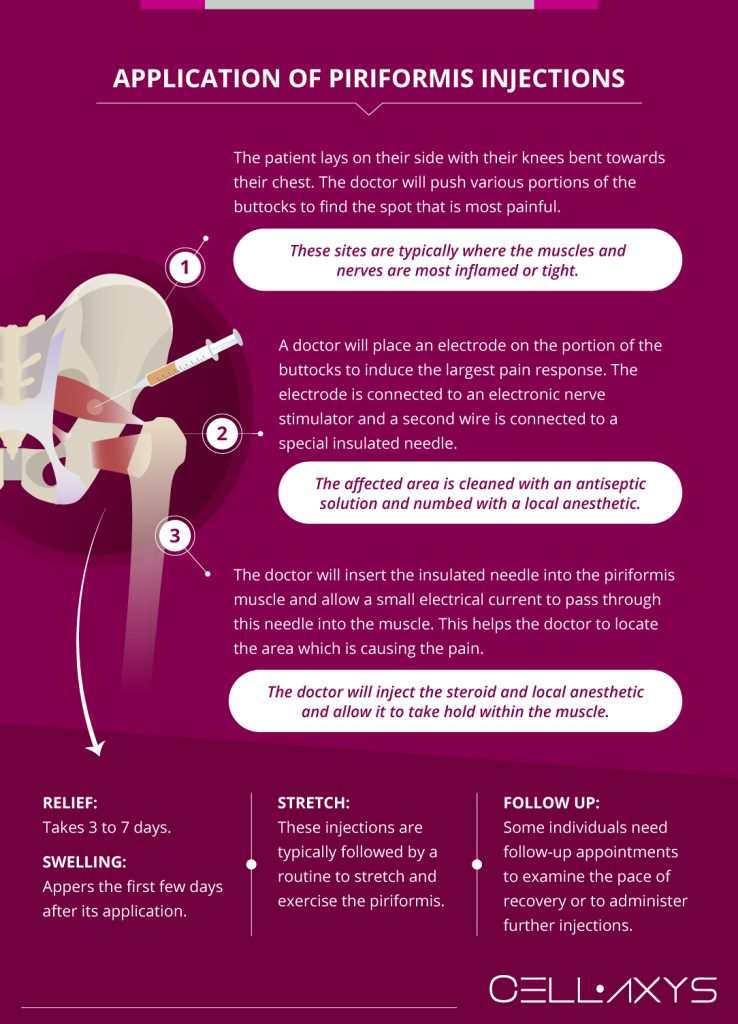 Regenerative Therapy Offers A Safe Alternative To Piriformis Injections ...