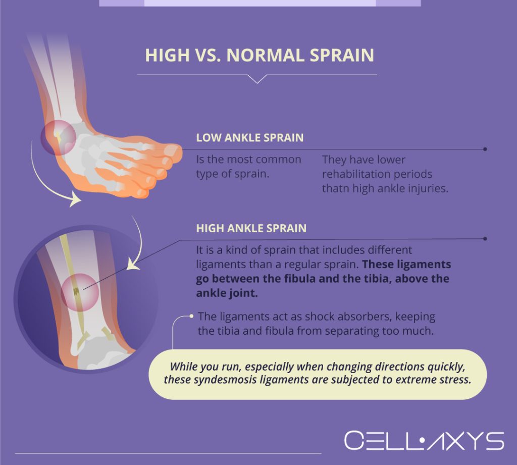 High Ankle Sprains And Regenerative Therapies Cellaxys