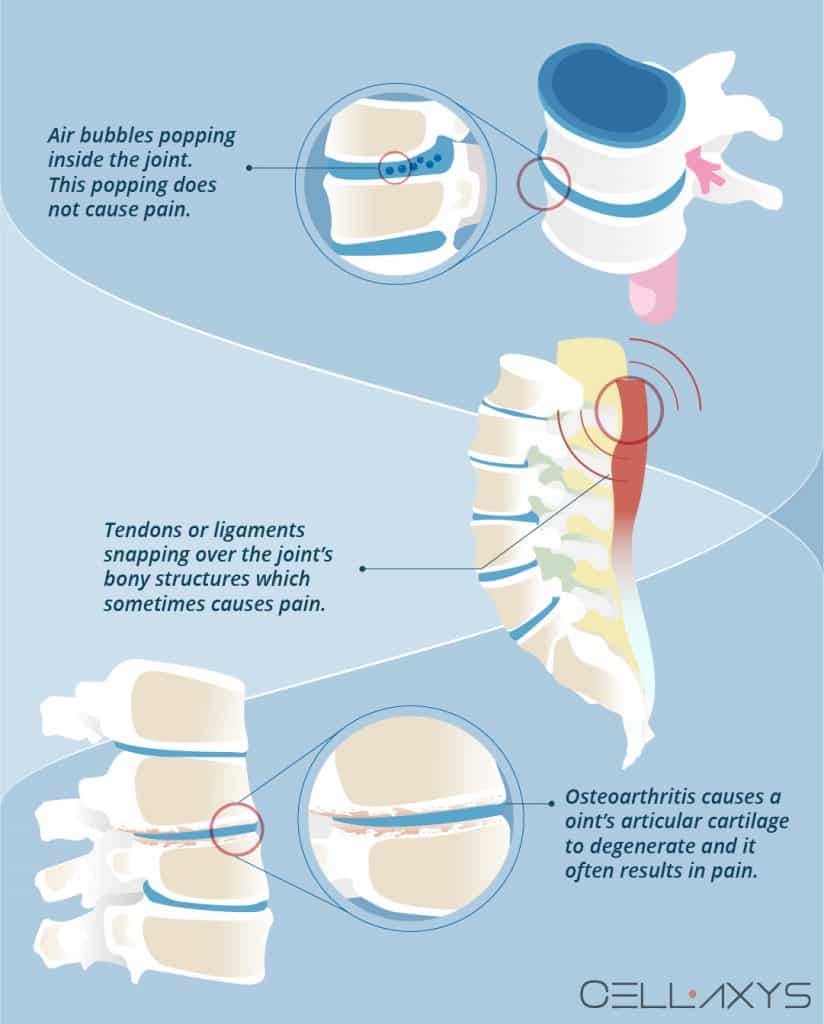 Causes Of Popping Noise In The Lower Back - Cellaxys
